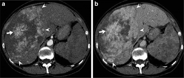 Primary hepatic angiosarcoma: multi-institutional comprehensive cancer ...