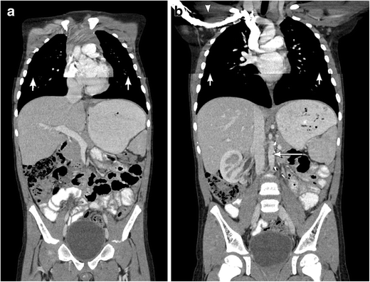 Dual bolus intravenous contrast injection technique for multiregion ...