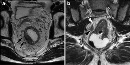 MRI-detected extramural vascular invasion is an independent prognostic ...