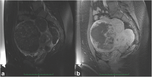 MRI predictors of clinical success in MR-guided focused ultrasound ...