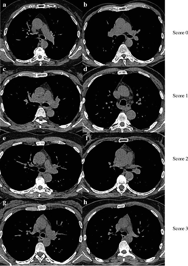 Normal thymus in adults: appearance on CT and associations with age ...