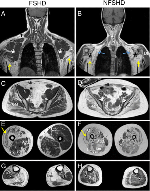 Muscle MRI findings in facioscapulohumeral muscular dystrophy ...