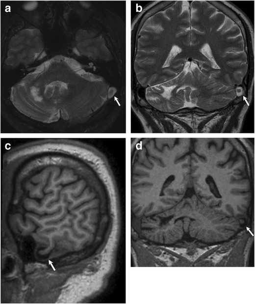 Brain herniations into the dural venous sinus or calvarium: MRI ...