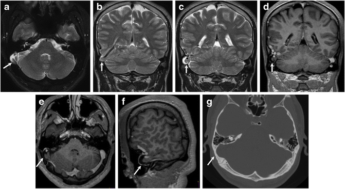 Brain herniations into the dural venous sinus or calvarium: MRI ...