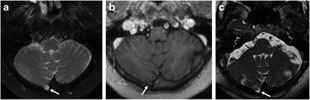 Brain herniations into the dural venous sinus or calvarium: MRI ...