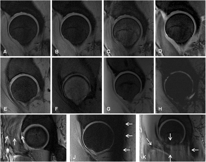 7 Tesla quantitative hip MRI: T1, T2 and T2* mapping of hip cartilage ...
