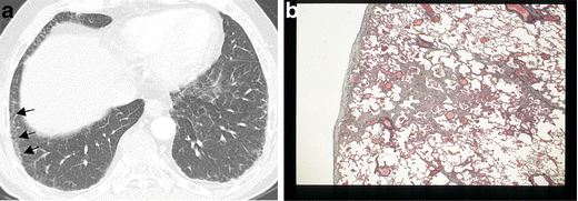 Asbestosis and other pulmonary fibrosis in asbestos-exposed workers ...