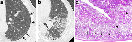 Asbestosis and other pulmonary fibrosis in asbestos-exposed workers ...