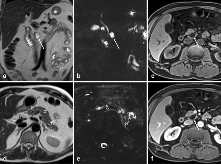 Pancreatic MRI for the surveillance of cystic neoplasms: comparison of ...