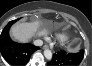 Arteries of the falciform ligament on C-arm CT hepatic arteriography ...