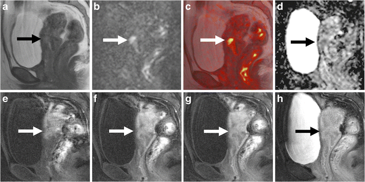 Endometrial cancer with cervical stromal invasion: diagnostic accuracy ...