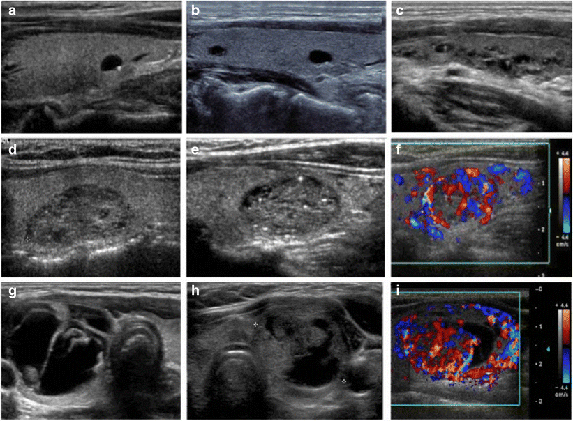 Prospective validation of the ultrasound based TIRADS (Thyroid Imaging ...