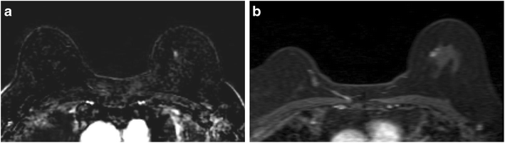 Management for BI-RADS category 3 lesions detected in preoperative breast MR imaging of breast ...