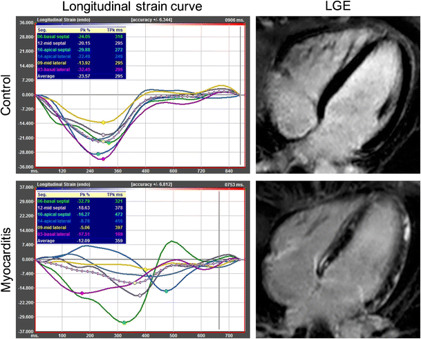 Feature-tracking myocardial strain analysis in acute myocarditis ...