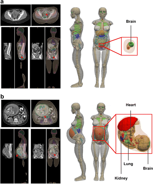 Assessment of CT dose to the fetus and pregnant female patient using patient-specific ...