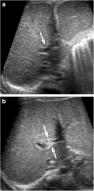 Early US findings of biliary atresia in infants younger than 30 days ...