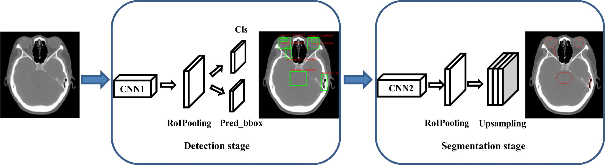 Deep-learning-based detection and segmentation of organs at risk in nasopharyngeal carcinoma ...