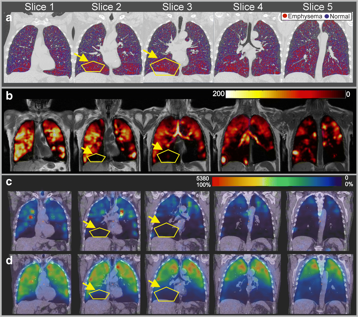 Time-series hyperpolarized xenon-129 MRI of lobar lung ventilation of ...