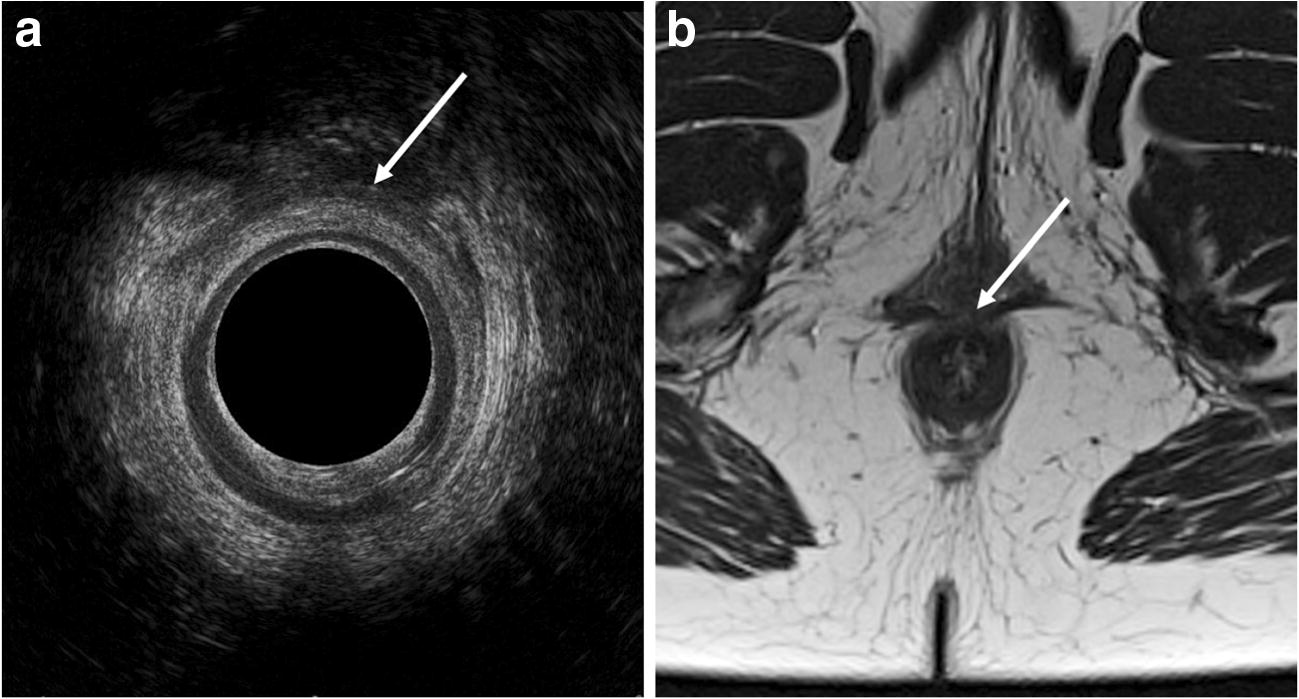 Comparison of 3D endoanal ultrasound and external phased array magnetic ...