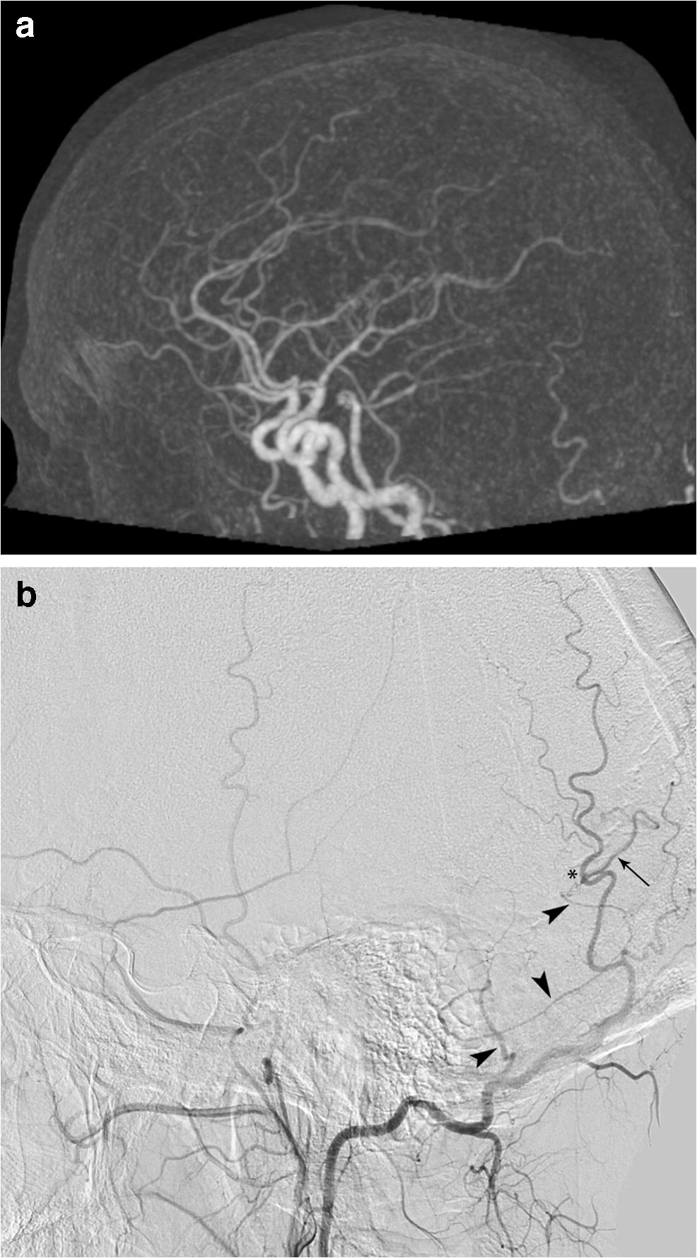 High sensitivity and specificity of 4D-CTA in the detection of cranial ...