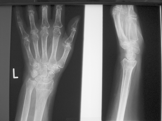 Morbus Sudeck an der Hand | SpringerLink