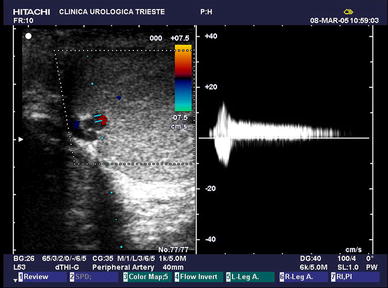 Intratesticular varicocele: evaluation using grey scale and color ...