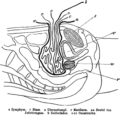 Johann Anton von Mikulicz-Radecki (1850–1905)—a pioneer of gastroscopy ...