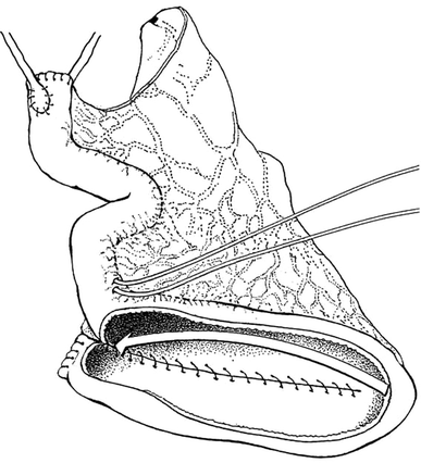 Does reflux in orthotopic diversion matter? A randomized prospective ...