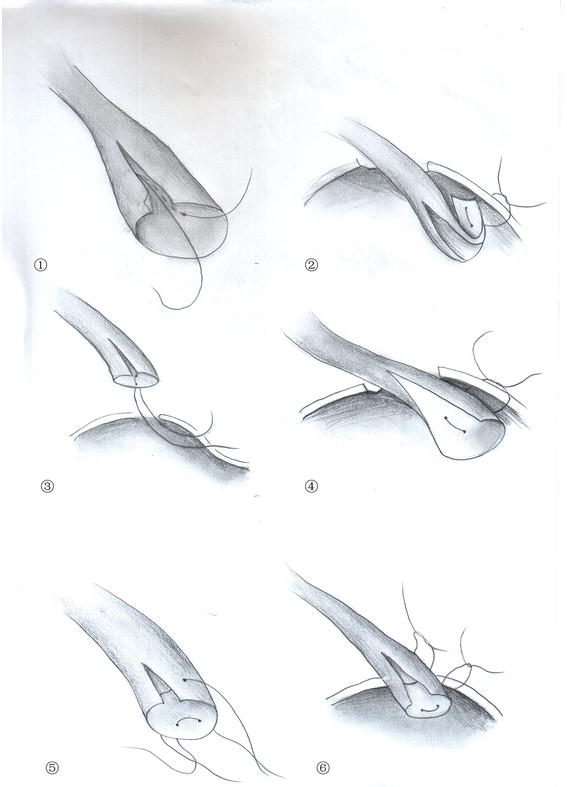 Comparative study of one-stitch versus Lich-Gregoir ureterovesical ...