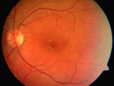 Bilaterale Panuveitis mit seröser Amotio retinae | Springer for ...