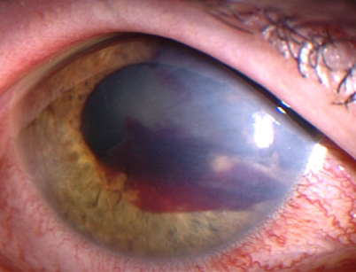 Ursache einer Contusio bulbi | SpringerLink