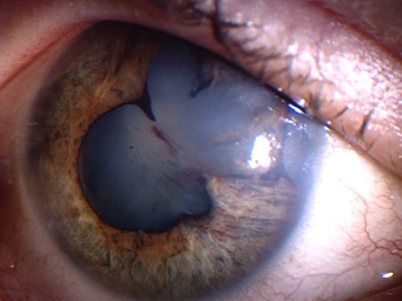 Ursache einer Contusio bulbi | SpringerLink