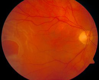 Ablatio retinae bei Kindern und Jugendlichen | SpringerLink