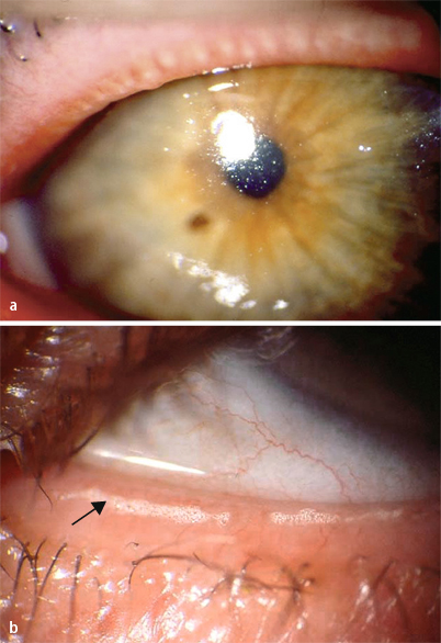 Meibom-Drüsen | SpringerLink