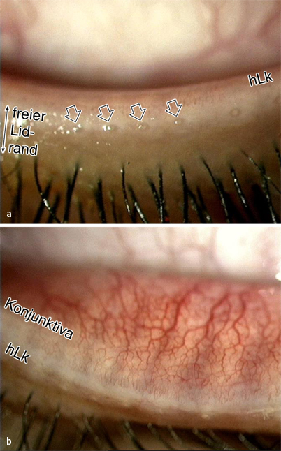 Meibom-Drüsen | SpringerLink