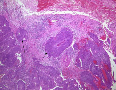 Malignome des Saccus lacrimalis | SpringerLink