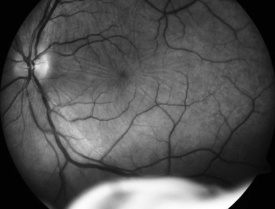 Aderhauttumor mit exsudativer Amotio retinae? | SpringerLink