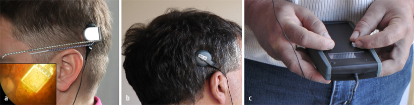 Was können blinde Patienten mit dem subretinalen Alpha-IMS-Implantat im ...