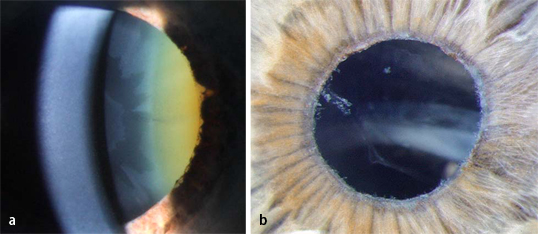 Pseudoexfoliationssyndrom | SpringerLink