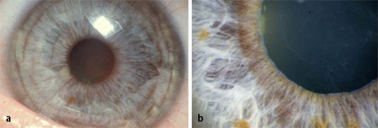 Pseudoexfoliationssyndrom | SpringerLink