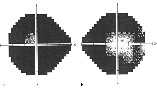 Beidseitige Stauungspapillen, einseitiger Visusverlust und ...