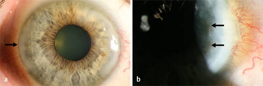 Bilaterale, limbusparallele, leicht prominente Trübungen in der ...
