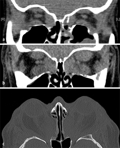 Update endokrine Orbitopathie | SpringerLink