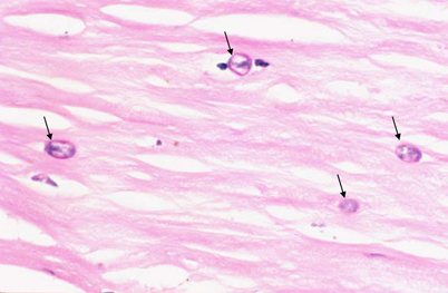 Akanthamöbenkeratitis | SpringerLink