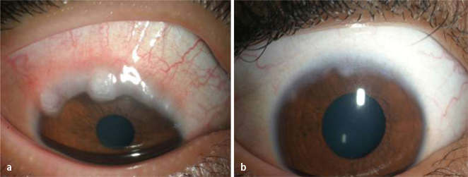 Keratoconjunctivitis vernalis | SpringerLink