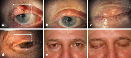 Ergebnisse nach Cutler-Beard-Plastik zur Rekonstruktion ausgedehnter ...