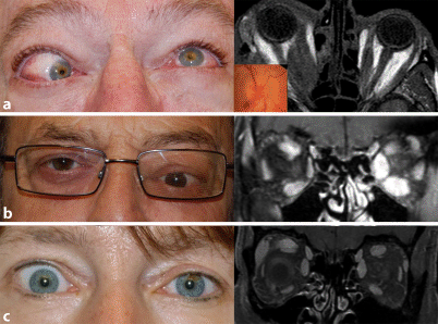 Endokrine Orbitopathie | SpringerLink