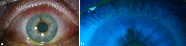 Endokrine Orbitopathie | SpringerLink