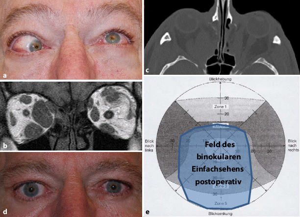 Endokrine Orbitopathie | SpringerLink