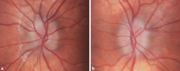 Differenzialdiagnose der Papillenschwellung | SpringerLink